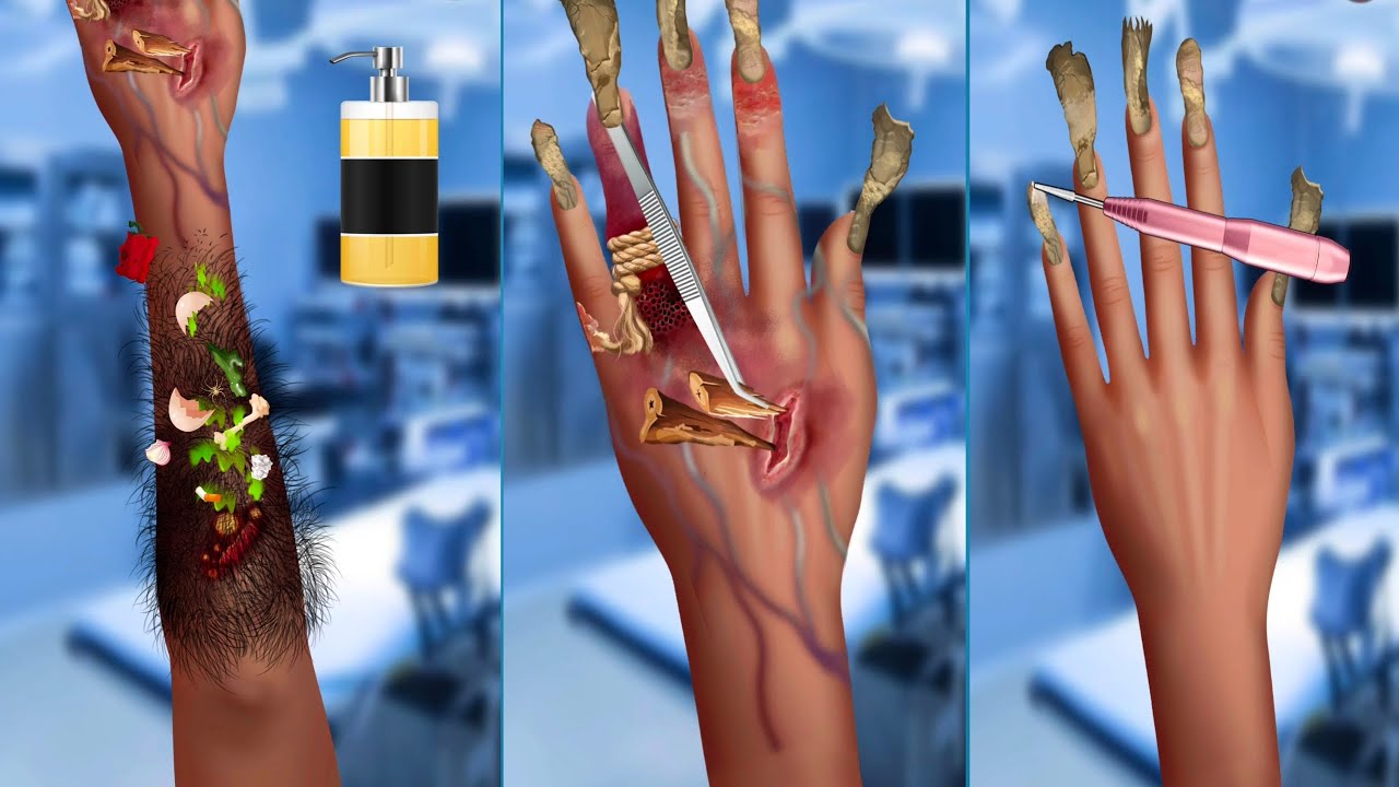 ASMR Remove Worm & Maggot Hand Infected | Asmr Worm Removal Animation ...