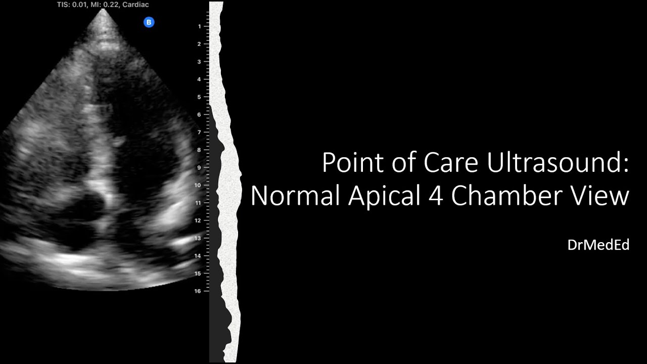 Point of Care Ultrasound (POCUS) - Normal Apical 4 Chamber View - YouTube
