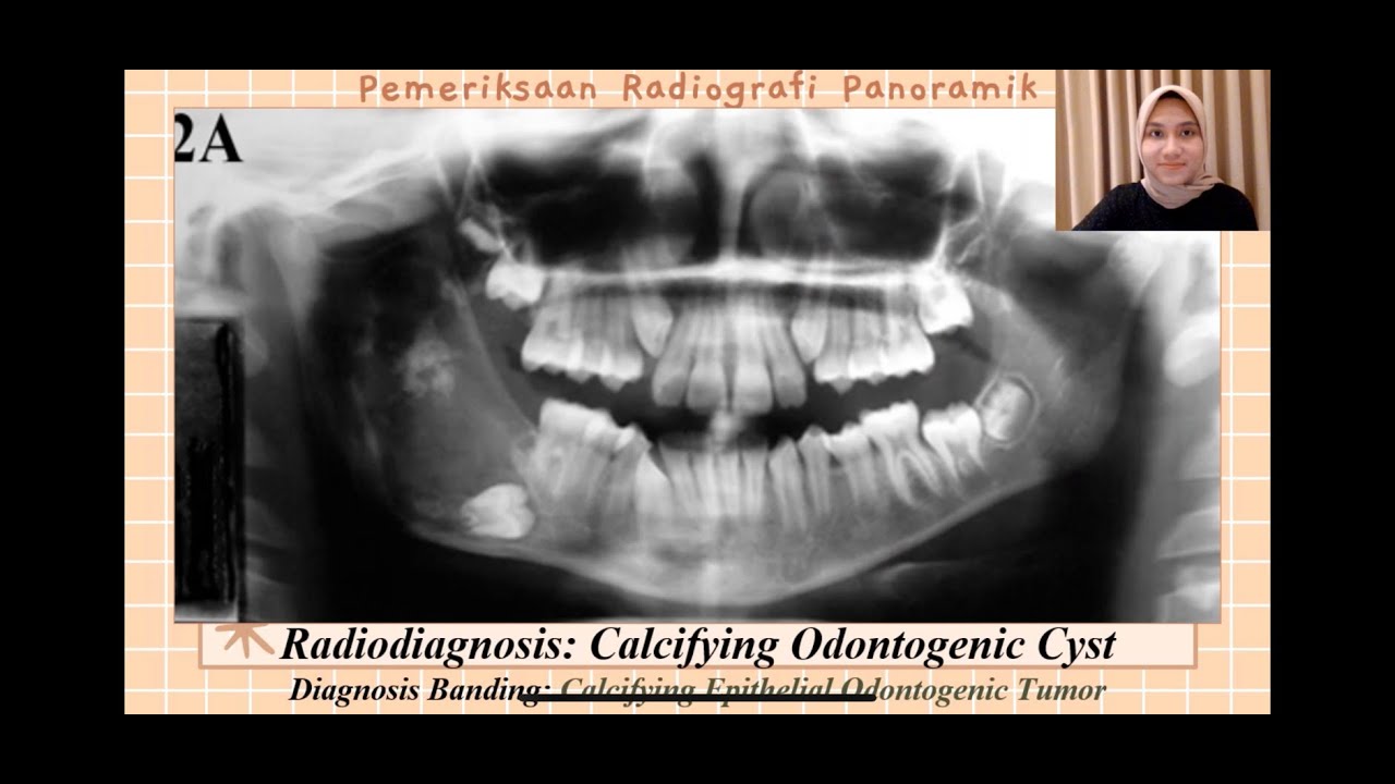 Calcifying Odontogenic Cyst Radiographic