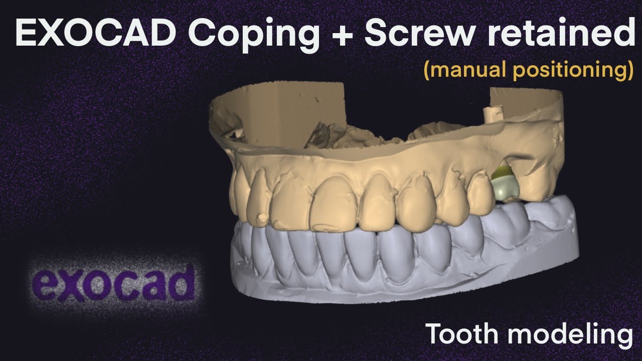 Exocad Coping + Screw retained (manual positioning) (Don`t use Scan ...