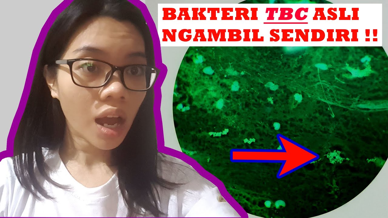 PENAMPAKAN ASLI KUMAN TBC TUBERCULOSIS TB | Radang paru-paru pneumonia ...