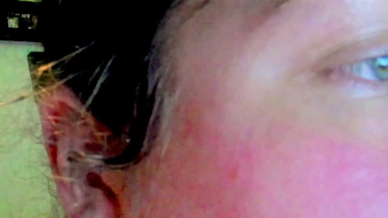 Eye Twitching (Fasciculations) - YouTube