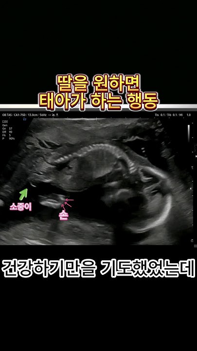 딸 아들 건강하면 좋아 초음파 태아 아기 성별 Youtube