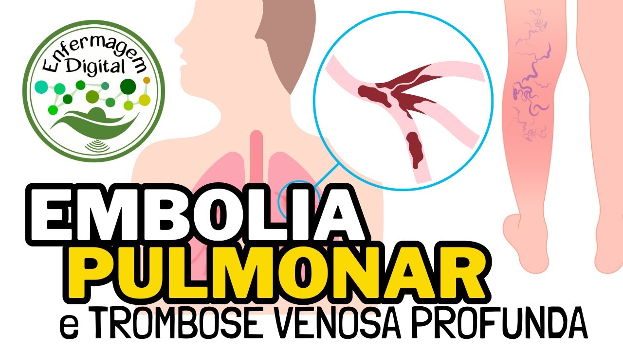 Embolia Pulmonar e Trombose Venosa Profunda - Aprenda a reconhecer suas ...