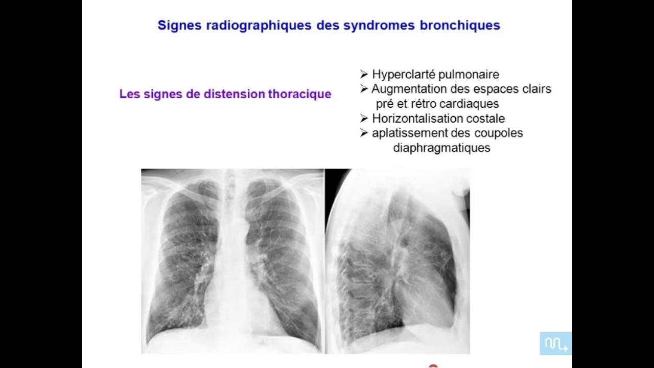 Les Grandes syndromes pulmonaires Partie 6 - YouTube