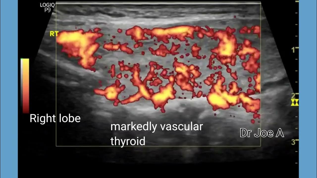 Hyperthyroidism ultrasound and color, power Doppler video, thyroid on ...