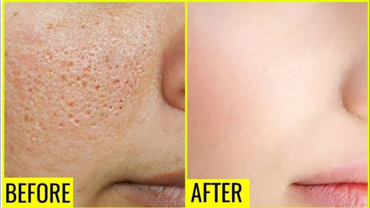 Get Rid Of Large Open Pores 100% Permanently Step By Step || Open Pores ...