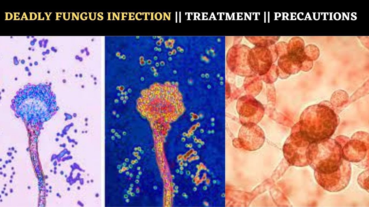 What is Deadly Fungal Infection | Treatment of Candida Auris: - YouTube