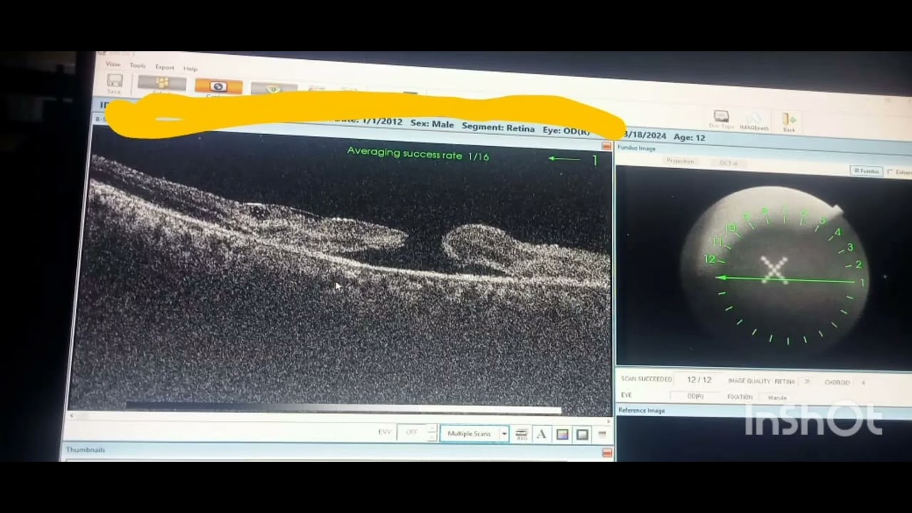 OCT findings-FTMH#ophthalmology #retinacare #residency #medical - YouTube