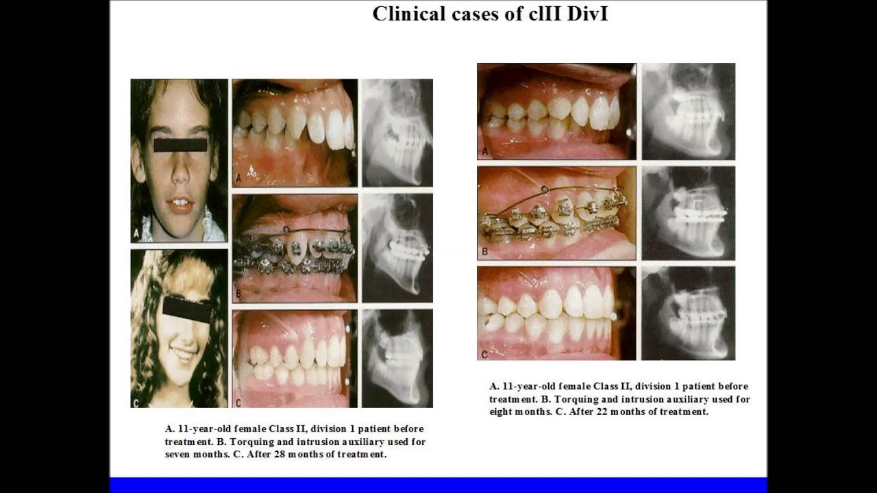 simultanious torquing and intrusion arch / orthodontic courses by ...