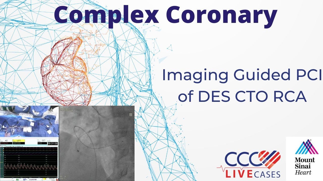Imaging Guided PCI of DES CTO RCA - YouTube