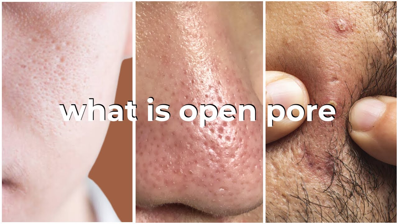 What Is OPEN PORES | Full Video on BeYourBest @BeYourBestOfficial - YouTube