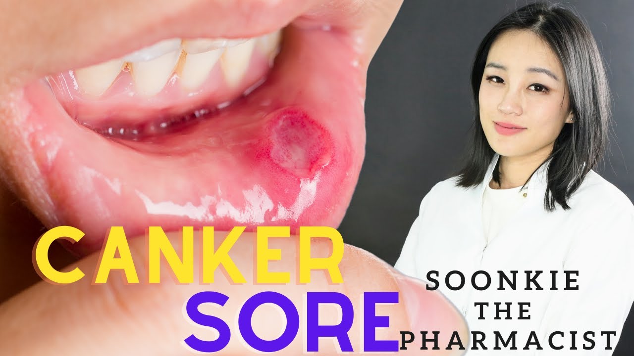How Do We Get Rid Of Canker Sores Mouth Ulcer Fast Prevention