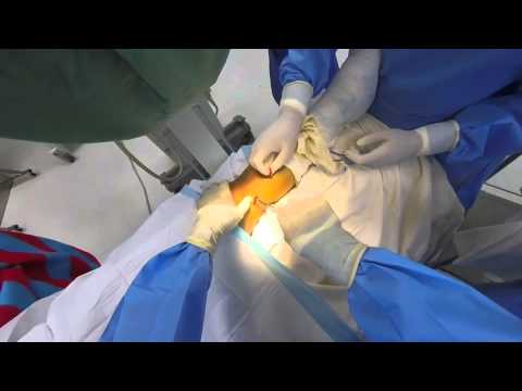 Percutaneous Cannulated Screws fixation - YouTube