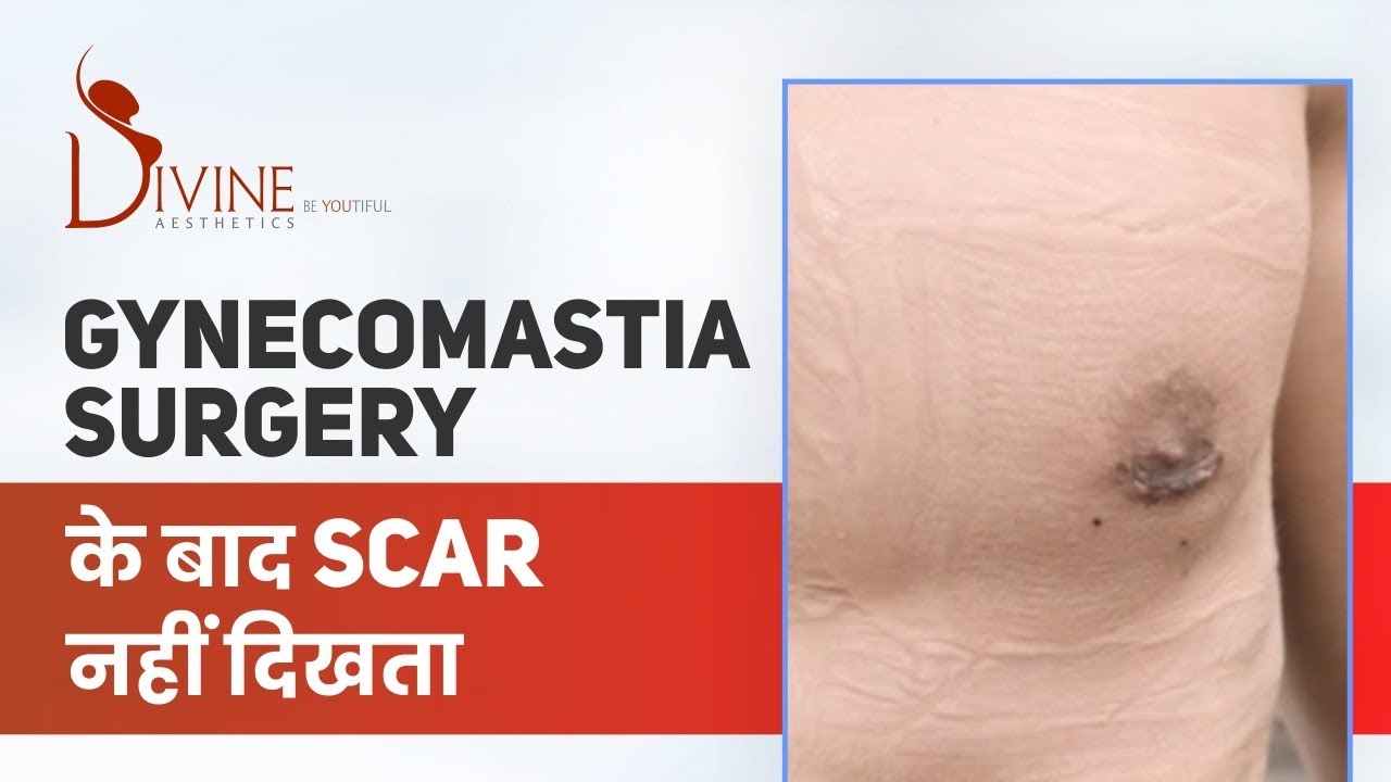 Gynecomastia Surgery के बाद Scar नहीं दिखता by Dr. Amit Gupta | Scar ...