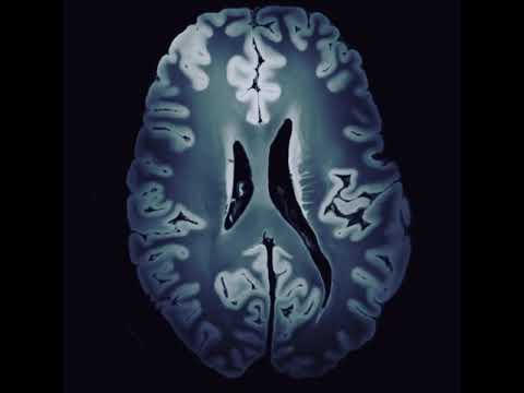 7 Tesla MRI - The Highest Resolution Image of the Brain in the World ...