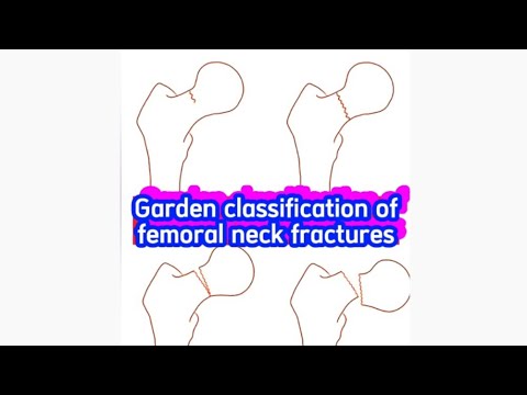 Garden classification of femoral neck fractures | femoral neck ...