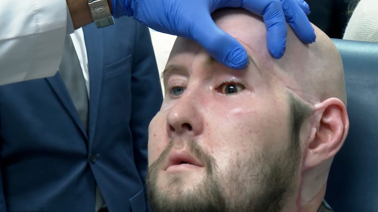 Man receives world’s first eye transplant after high-voltage electrical ...