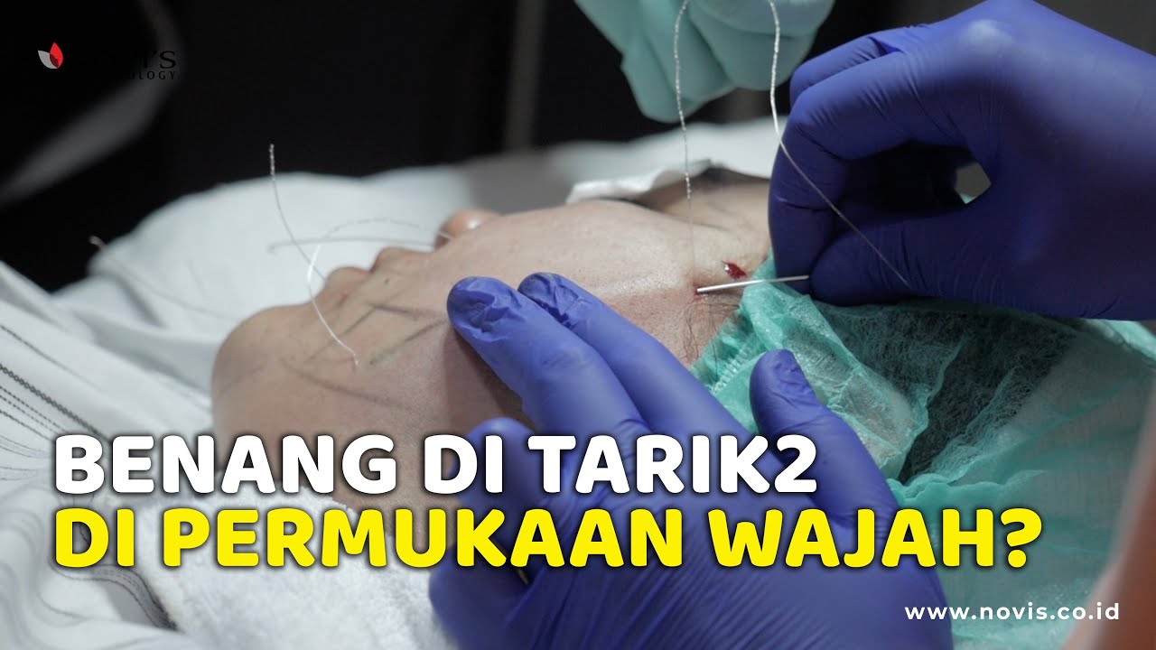 Prosesing Untuk Treatment Tarik Benang Pada Wajah || NOVI'S - YouTube
