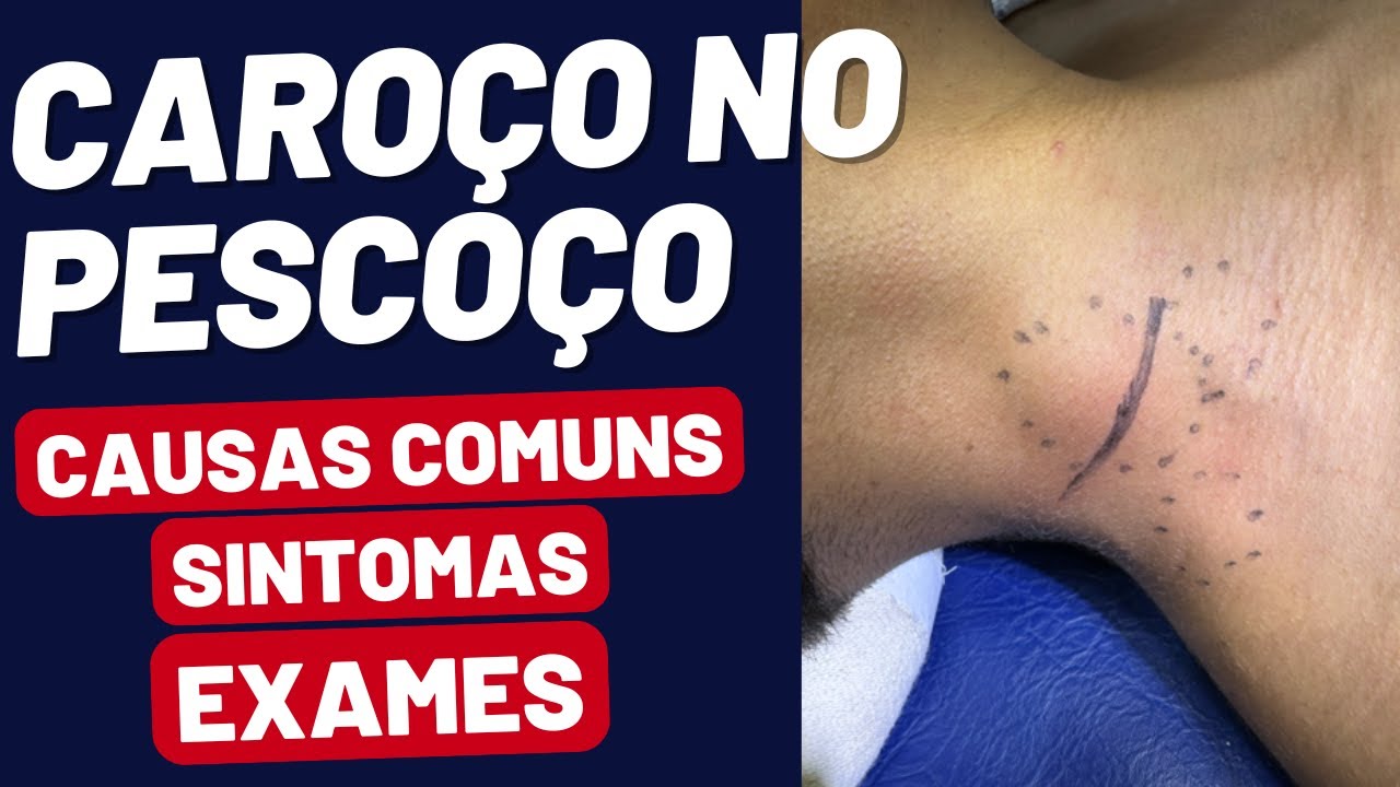 CAROÇO NO PESCOÇO: É GRAVE? Sintomas, Causas e Exames Explicados! - YouTube