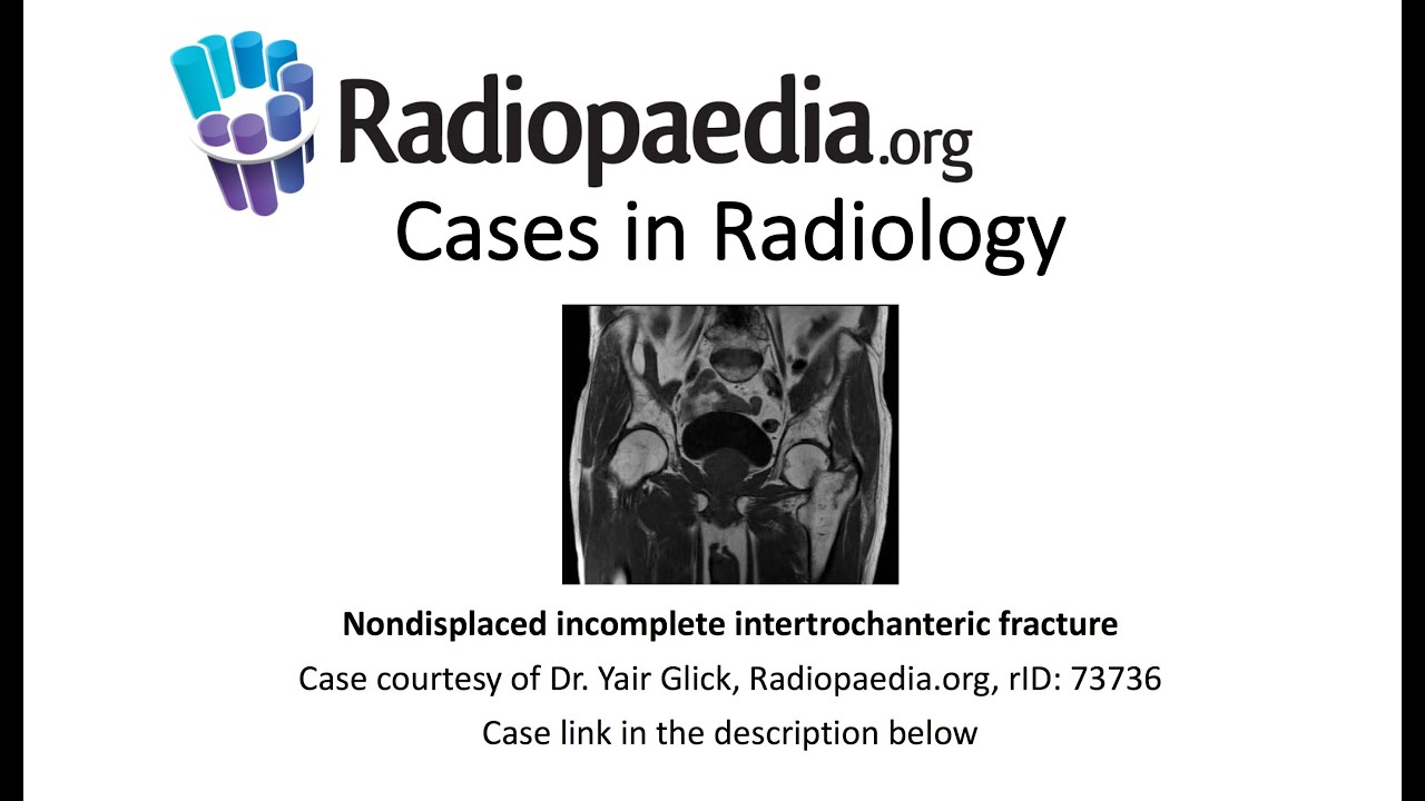 Nondisplaced incomplete intertrochanteric fracture (Radiopaedia.org ...