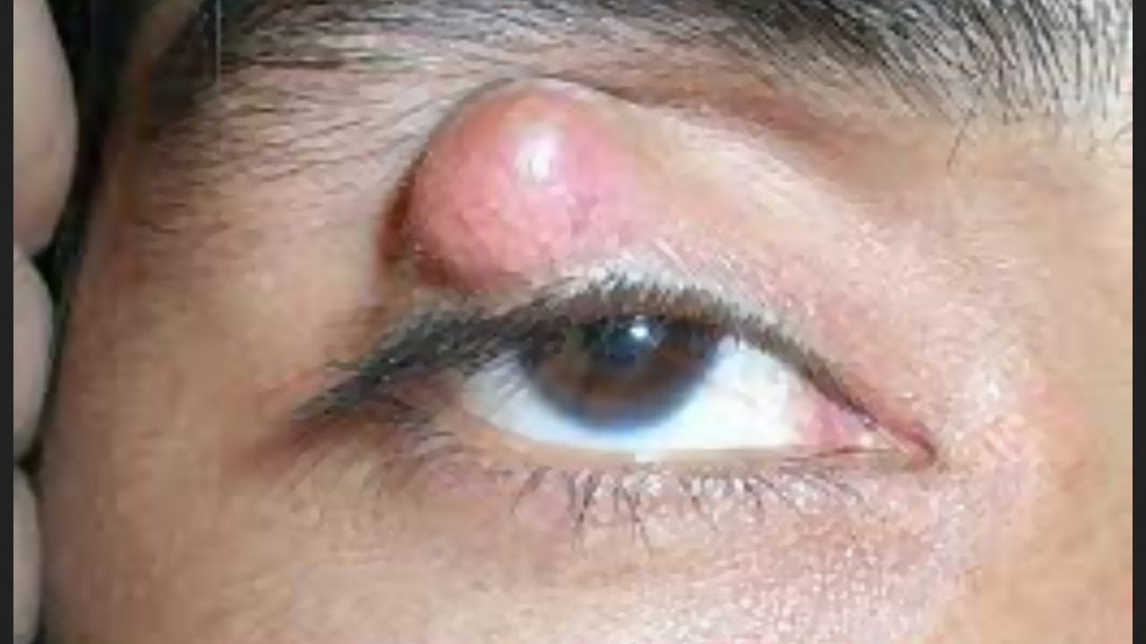 Chalazion or Stye, What is the Difference? - YouTube