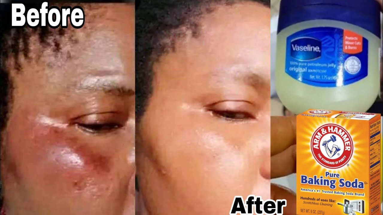 BAKING SODA AND VASELINE CAN TRANSFORM YOUR SKIN FROM DULL TO SPOTLESS ...
