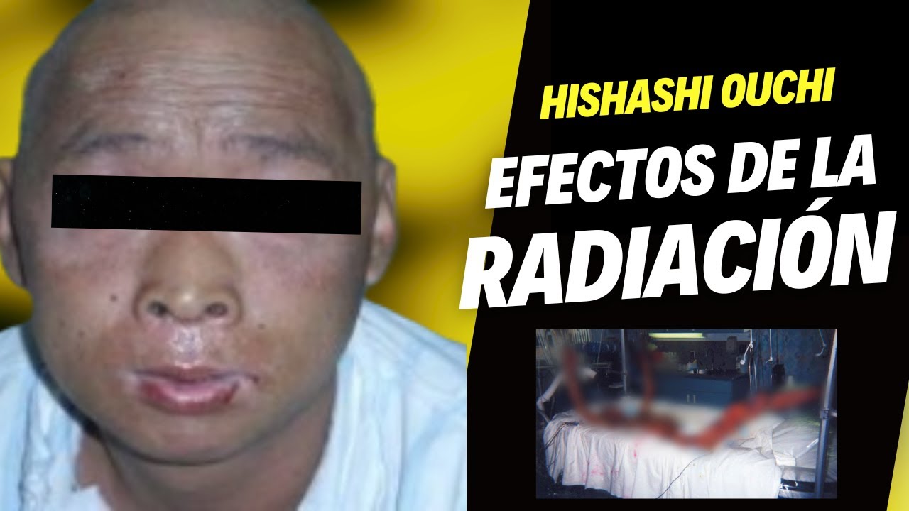 La RADIACIÓN Destruyó su cuerpo I Caso Hishashi Ouchi - YouTube