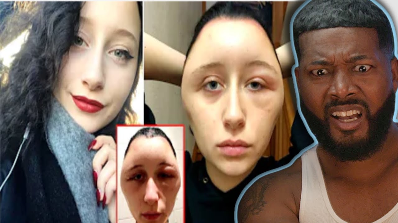 When Allergic Reactions Go Wrong | REACTION - YouTube