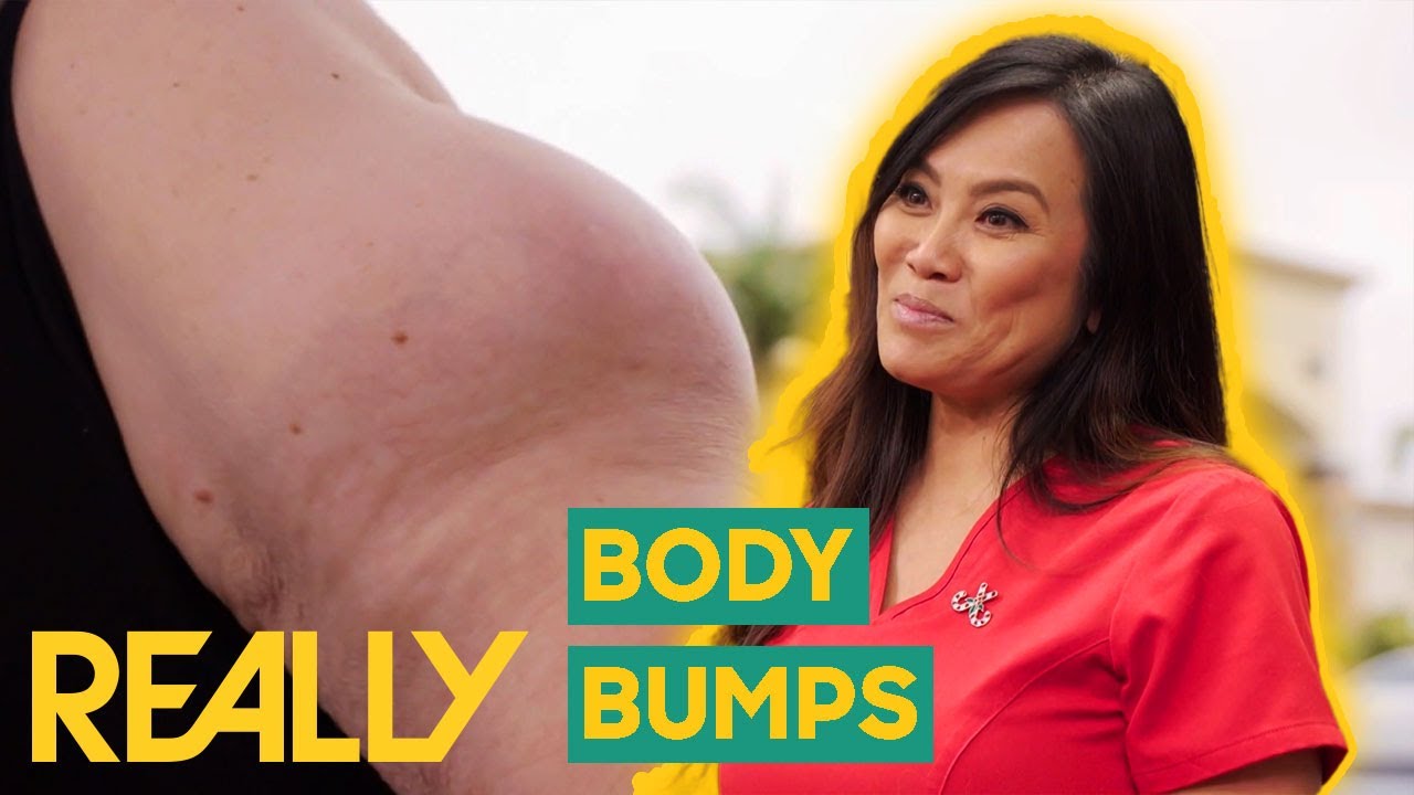 Dr. Lee Helps Patients With Body Bumps All In The SAME DAY! | Dr ...