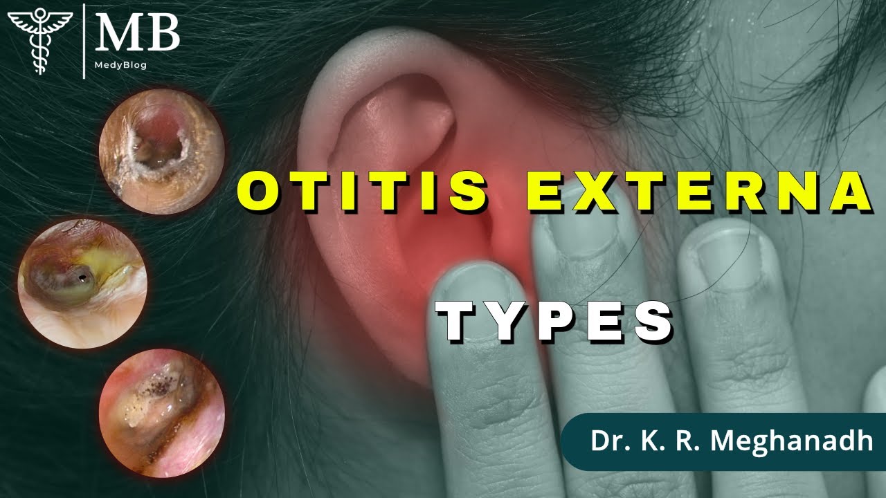 Types of Outer Ear Infections| Dr. K. R. Meghanadh | Medyblog - YouTube