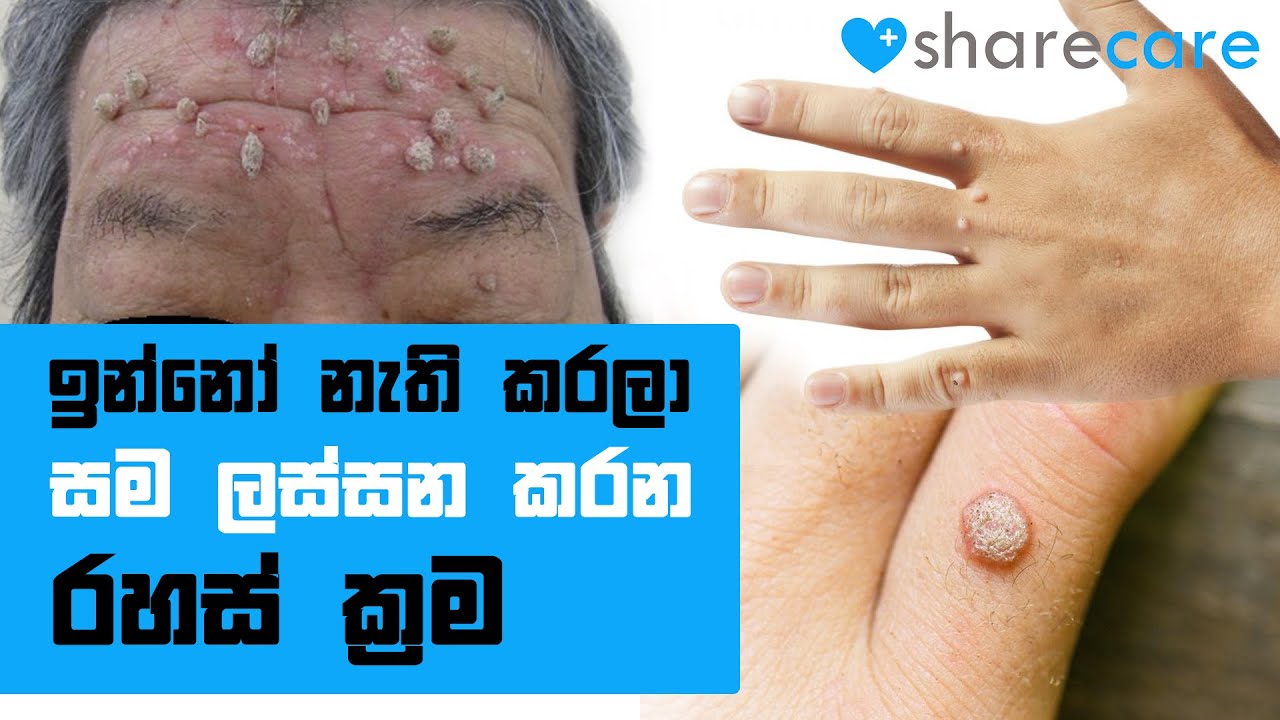Home Treatment for Warts | ඉන්නෝ නැති කරලා, සම ලස්සන කරන රහස් ක්‍රම ...