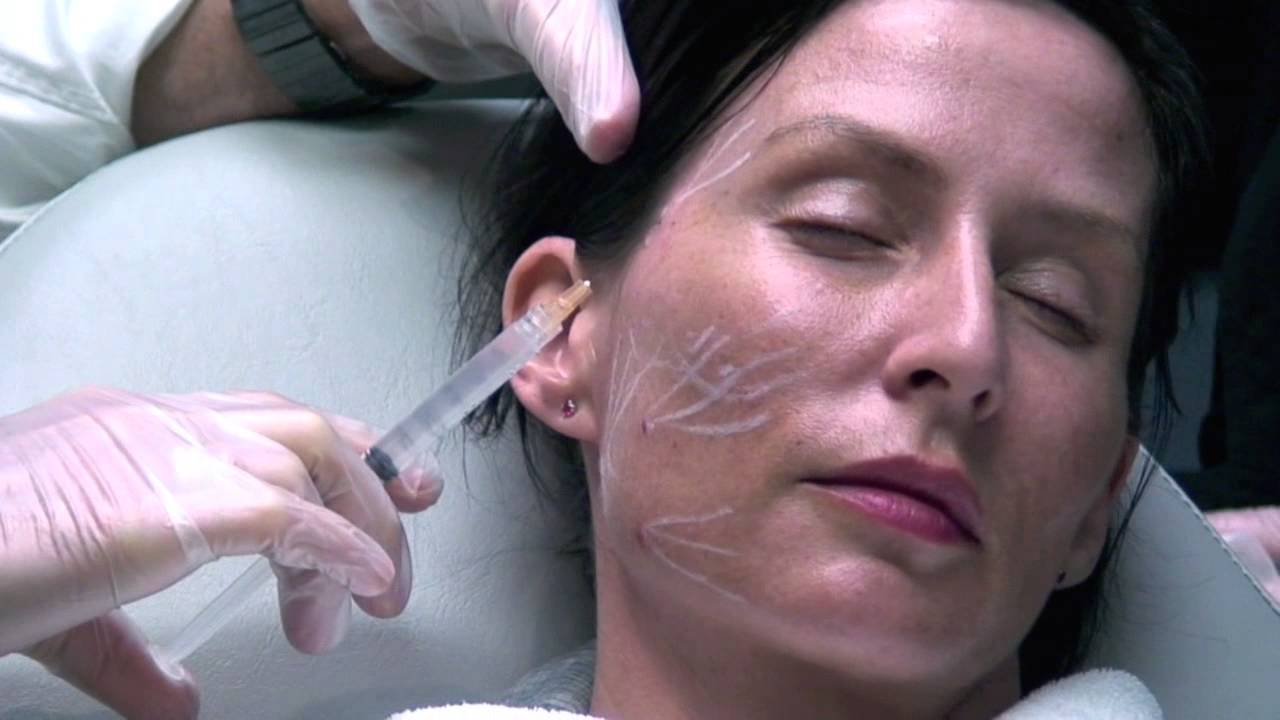 Sculptra for temples and hollow cheeks: Watch live injections with Dr ...