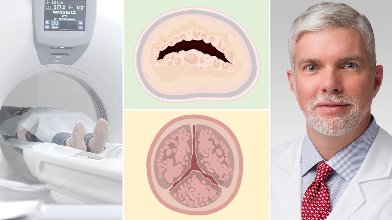 Surgeon Q&A: Radiation Associated Heart Valve Disease with Dr. Douglas ...