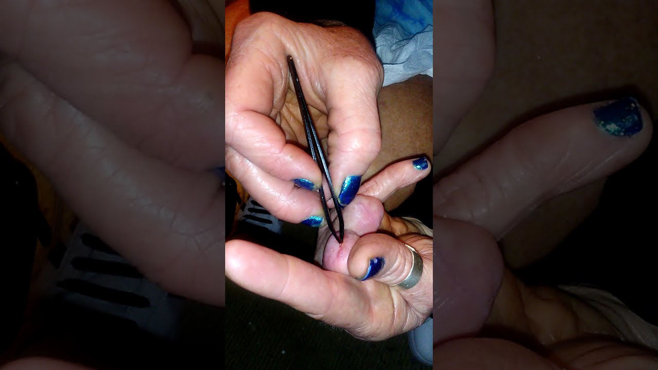 Finger Amputee Removes Own Stitches Youtube