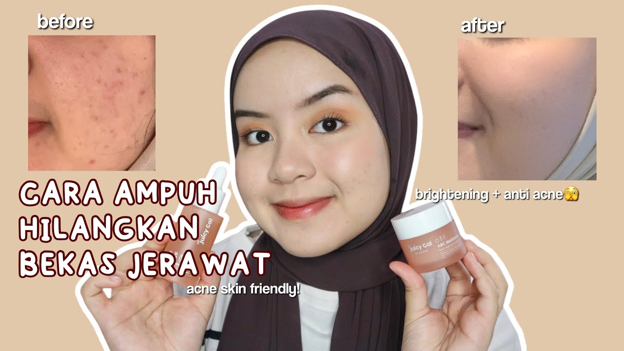 Skincare Routine untuk Bekas Jerawat Gelap & Merah (PIE/PIH) - Kulit Oily & Acne Prone - YouTube