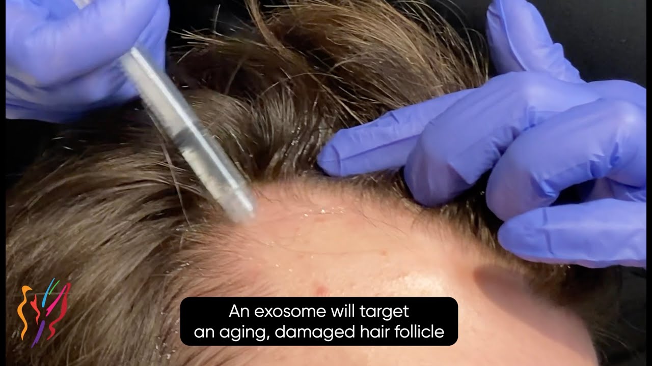 Revolutionizing Hair Loss Treatment Discover Exosome Therapy for ...