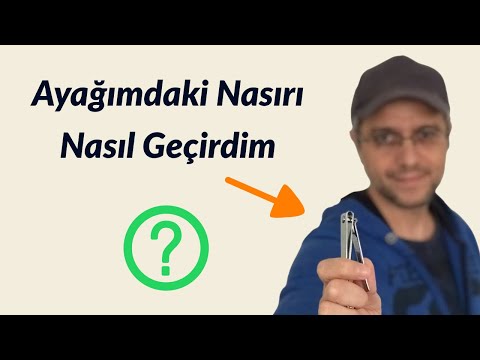 Ayağımdaki Nasırı Nasıl Geçirdim? (Çok Şaşıracaksınız)