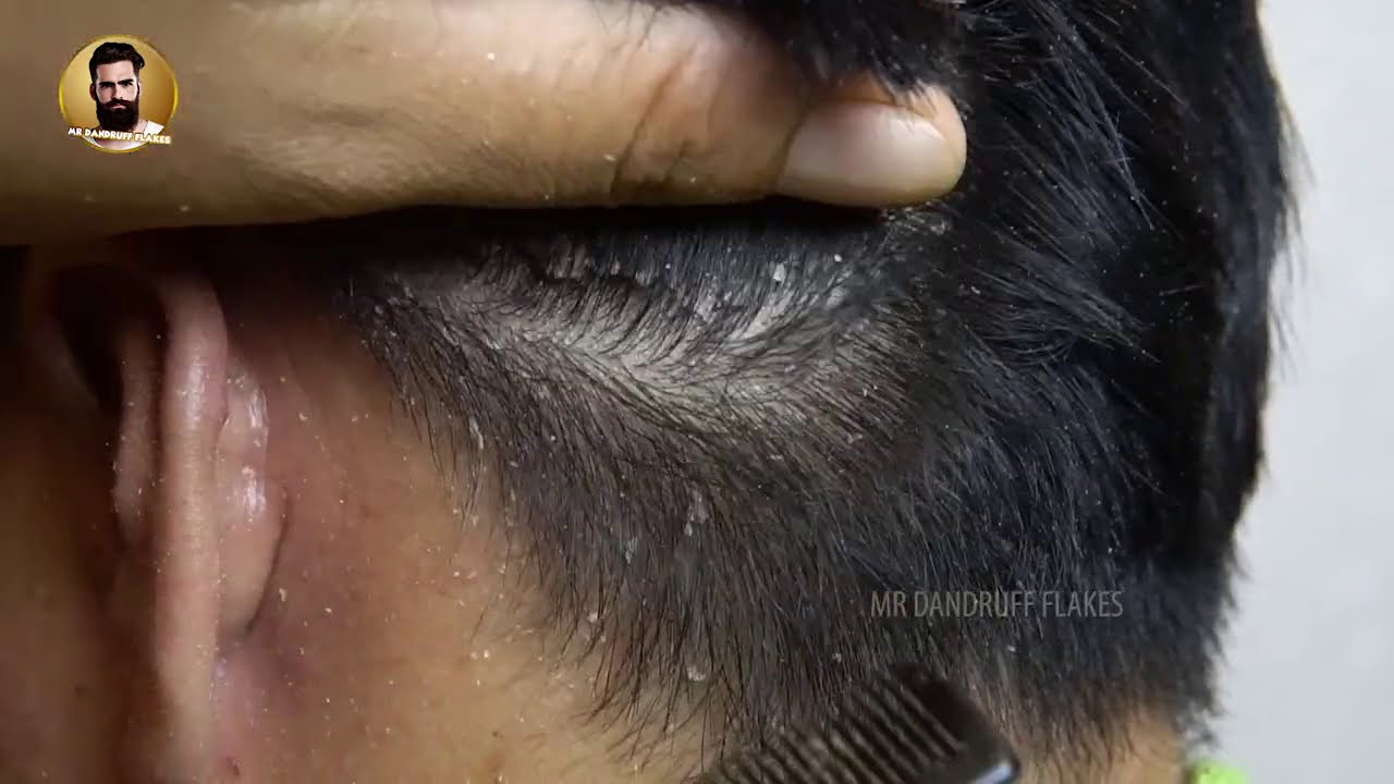 Big Flakes Scalp Scratching And Picking #60 - YouTube