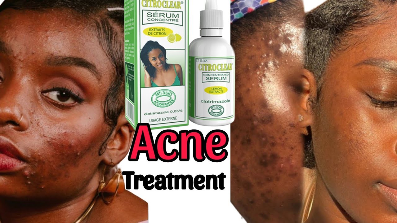 How To Use Citroclear Oil For Knuckles And Acne #howto #skincareproduct ...