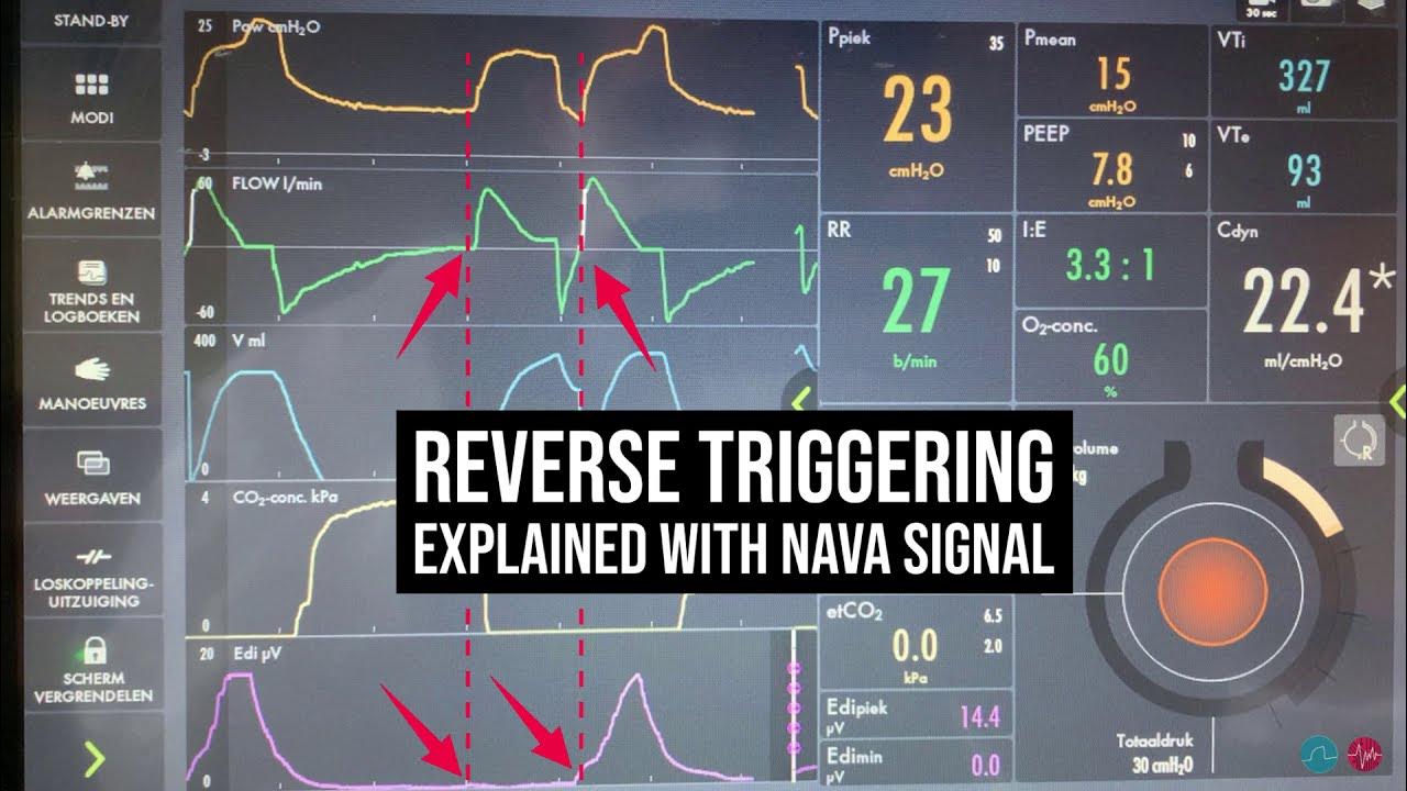 Reverse Triggering with NAVA signal - YouTube