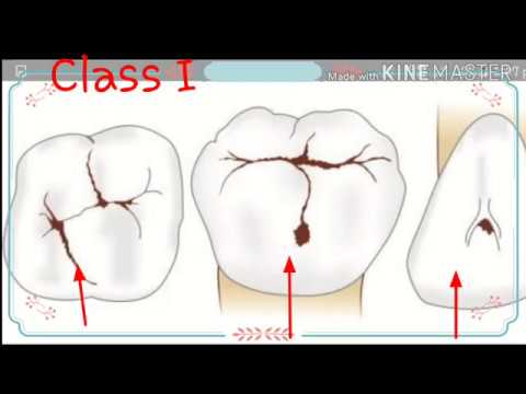 Classification of dental caries ( JV Black's Classification of dental ...