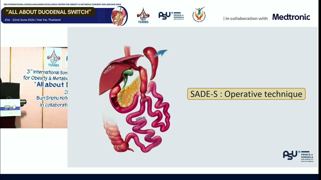 Single Anastomosis Duodenal Switch Sads Sadi S Experience And