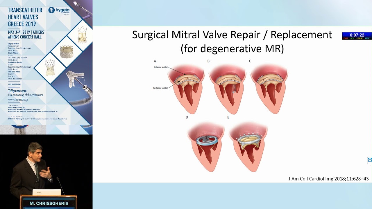 M. Chrissoheris | Echocardiographic evaluation of the mitral valve. - YouTube