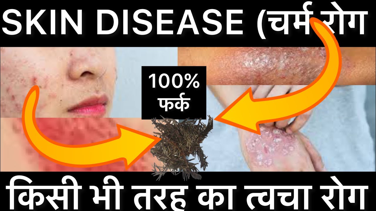 SKIN DISEASE (चर्म रोग)को खत्म करने का सिर्फ 1 तरीका||ECZEMA ,PSORIASIS ...