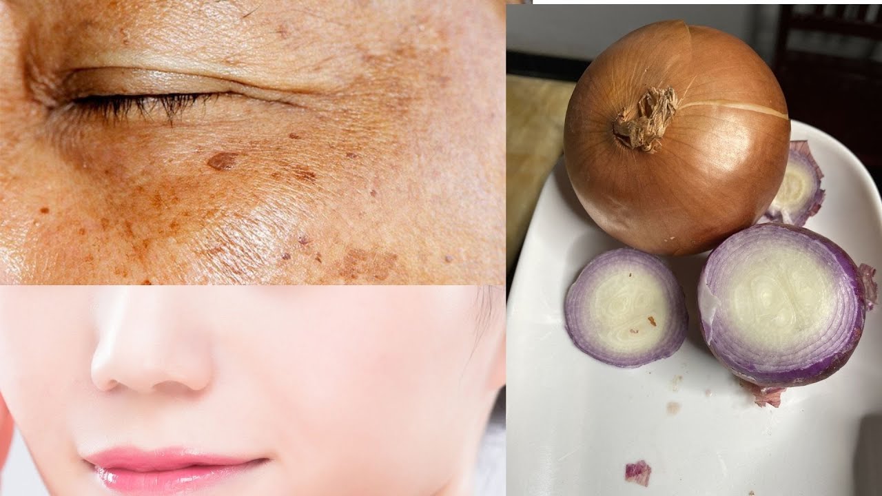 GET RID OF AGE SPOTS WITH ONIONS IMMEDIATELY - YouTube