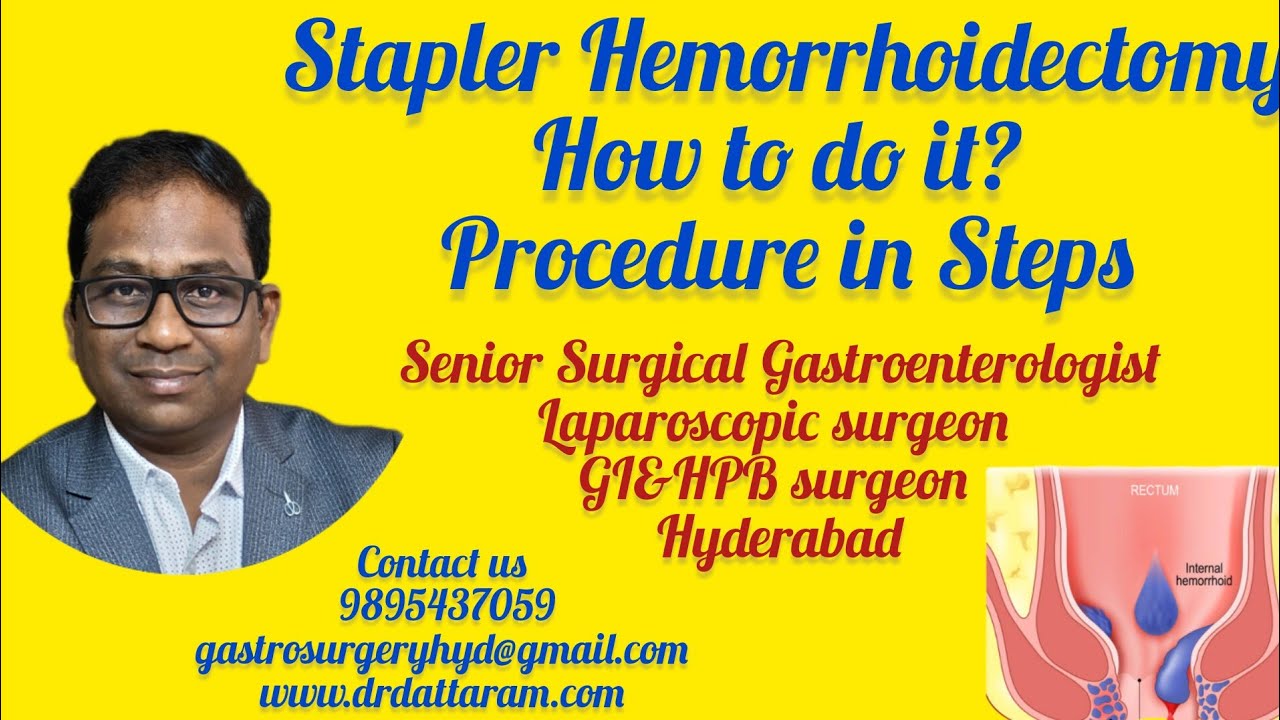Stapler Hemorrhoidectomy # Surgery for Hemorrhoids #Piles Surgery - YouTube