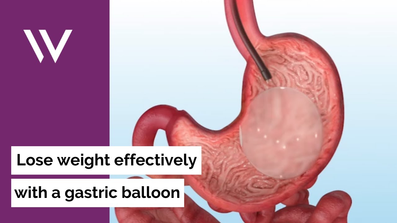 The Gastric Balloon procedure explained: A non-invasive accelerator for ...