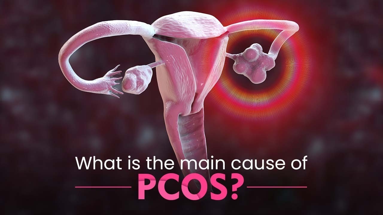 What is the main cause of PCOS? - YouTube