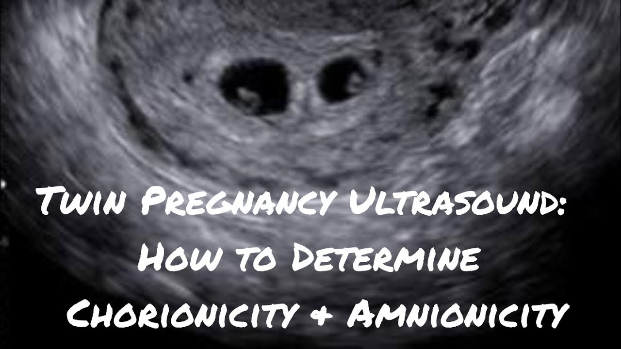 Twin Pregnancy Ultrasound: How to Determine Chorionicity & Amnionicity ...